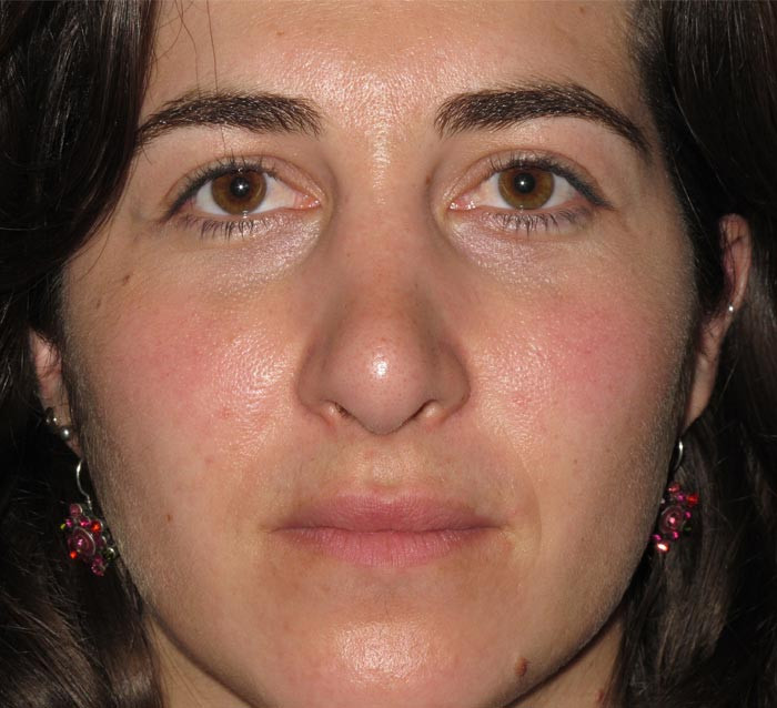 Piel con rojeces | Casos de éxito por tratamiento | Farmacia Jiménez