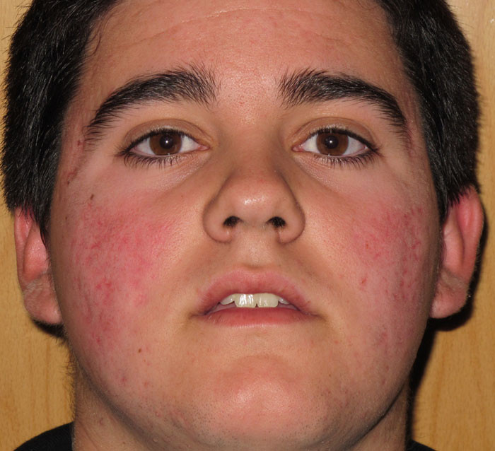 Acné cicatrices | Casos de éxito por tratamiento | Farmacia Jiménez