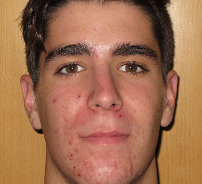 Acné cicatrices | Casos de éxito por tratamiento | Farmacia Jiménez