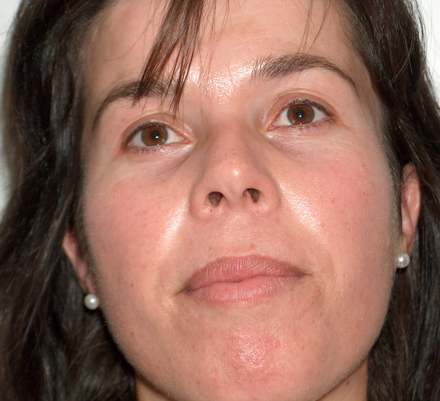 Acné rosacea | Casos de éxito por tratamiento | Farmacia Jiménez