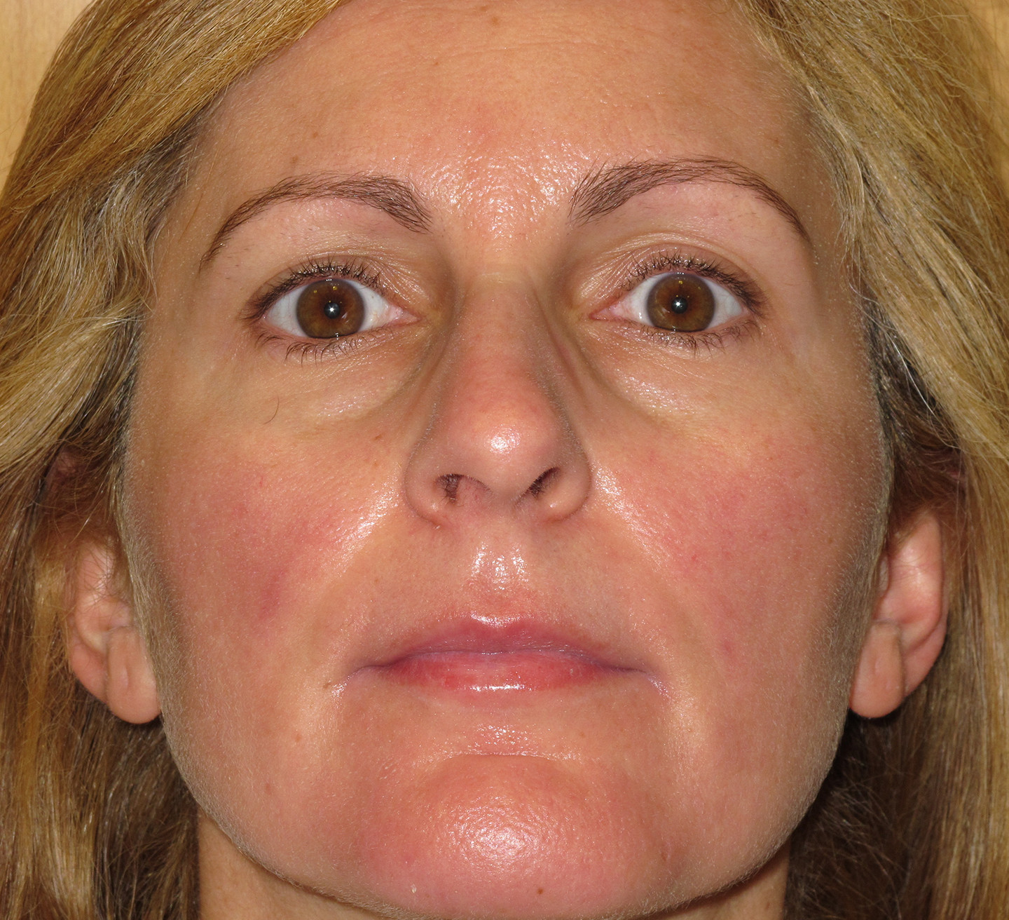 Piel con rojeces | Casos de éxito por tratamiento | Farmacia Jiménez